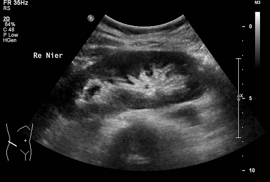 Echo en scan van nieren | Nierstichting